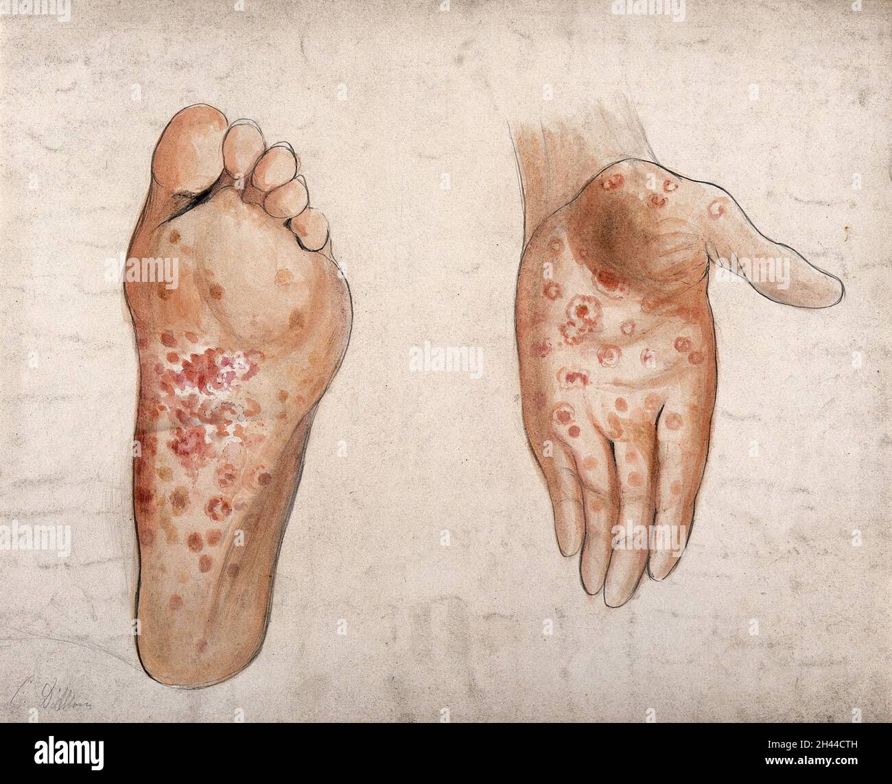 Diseased tissue on the palm of the hand and sole of the foot of a man ...