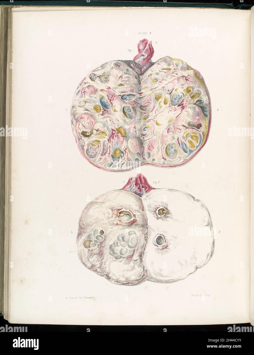 Hydatid hi-res stock photography and images - Alamy