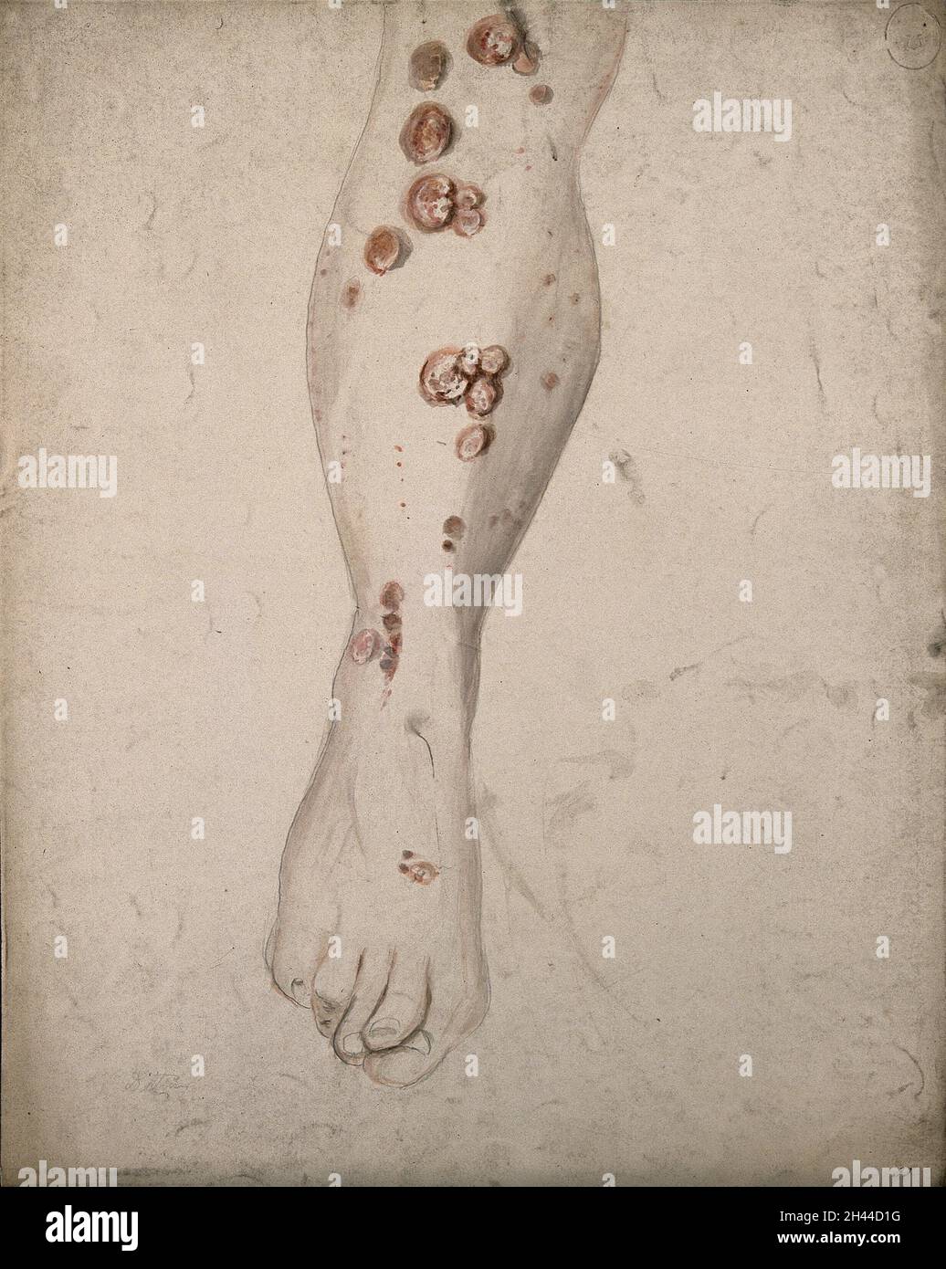 Sores and diseased skin on the leg of a woman. Watercolour by C. D ...