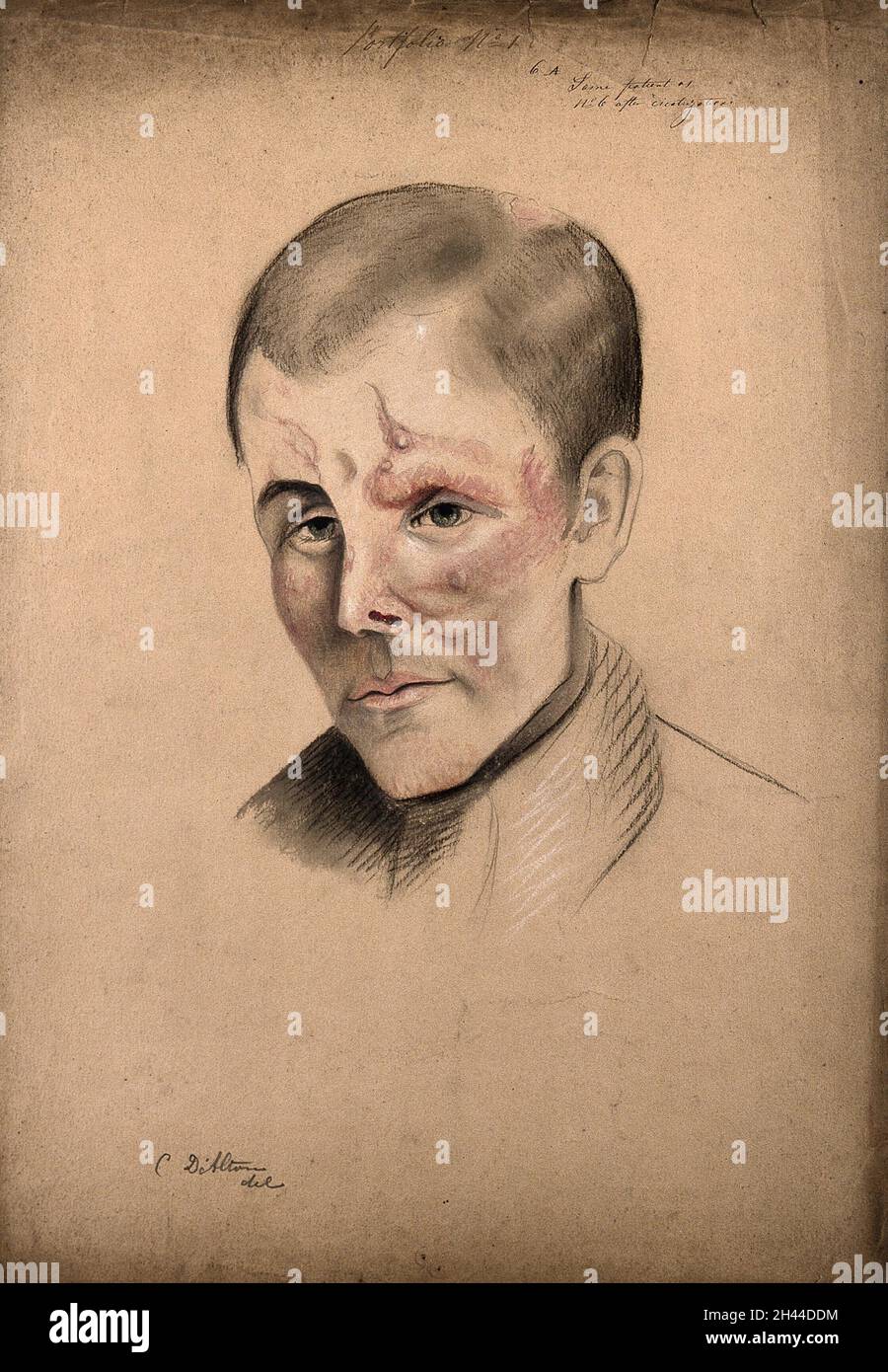 Head of a man with a severe disease affecting his face. Drawing by ...