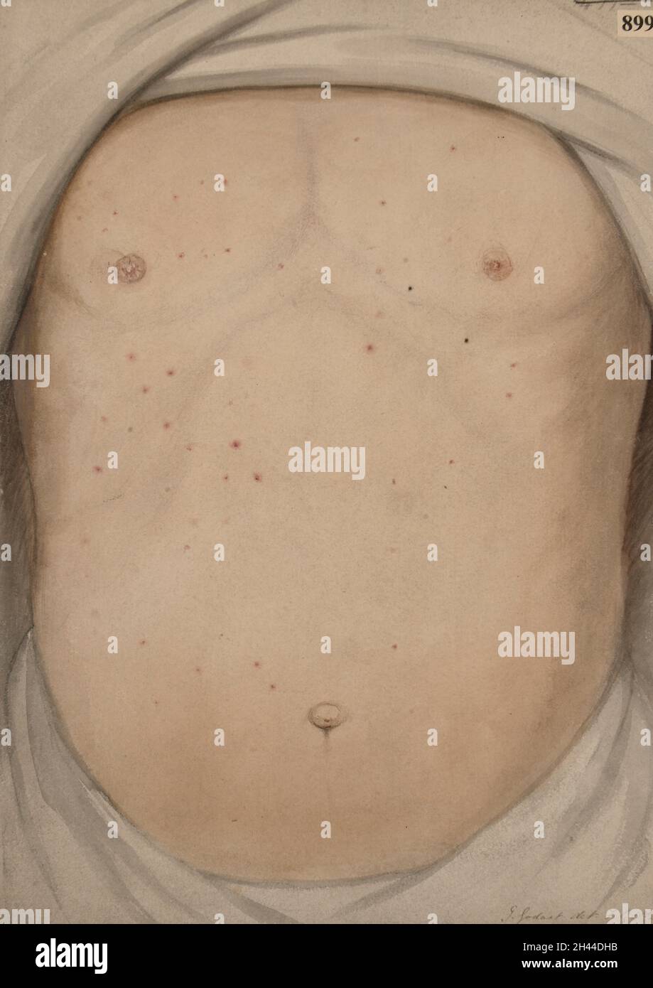 Chest and abdomen of a patient with unusually copious typhoid eruptions ...
