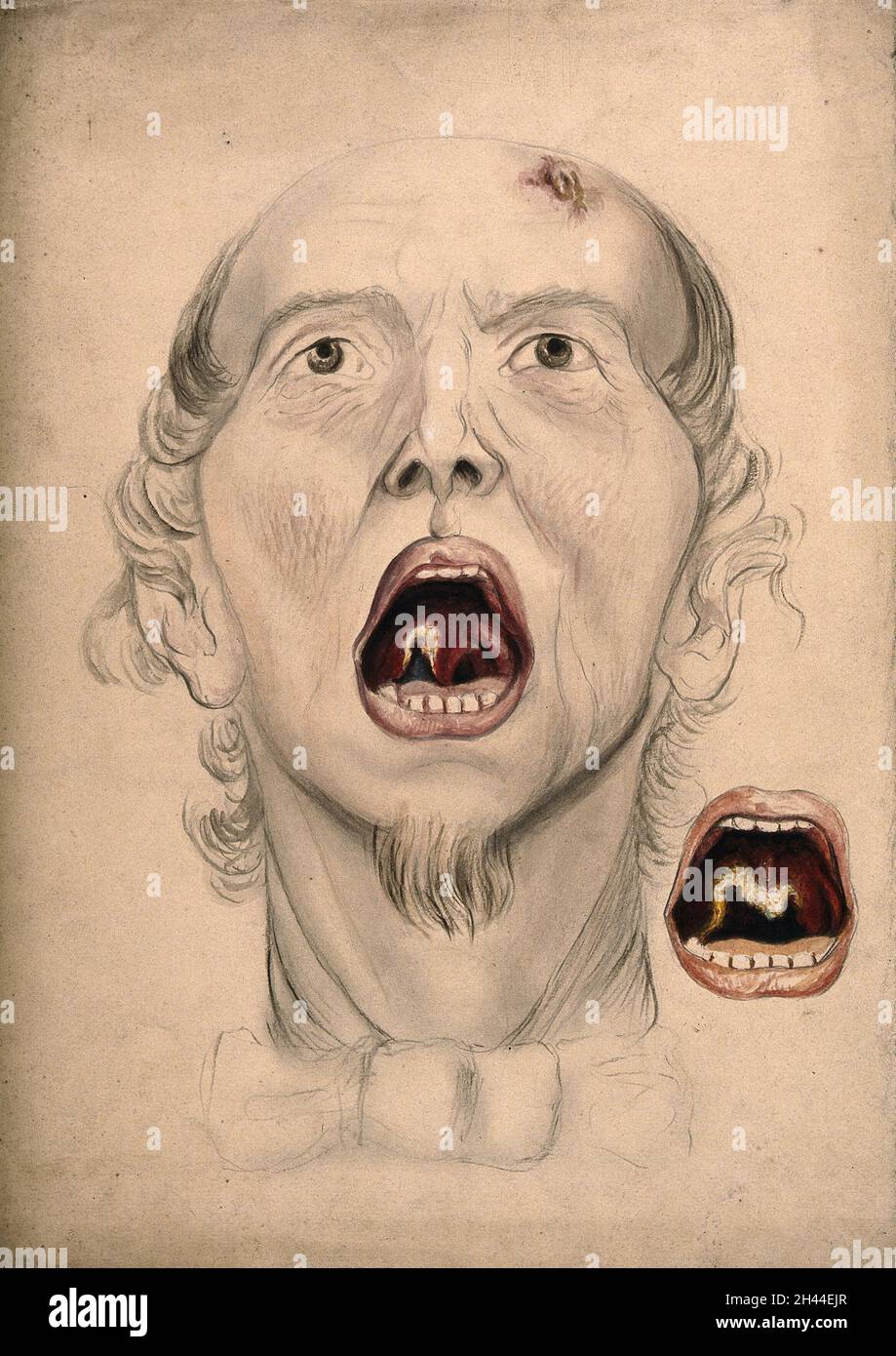 The face of a man, with mouth open wide, displaying a diseased area of ...