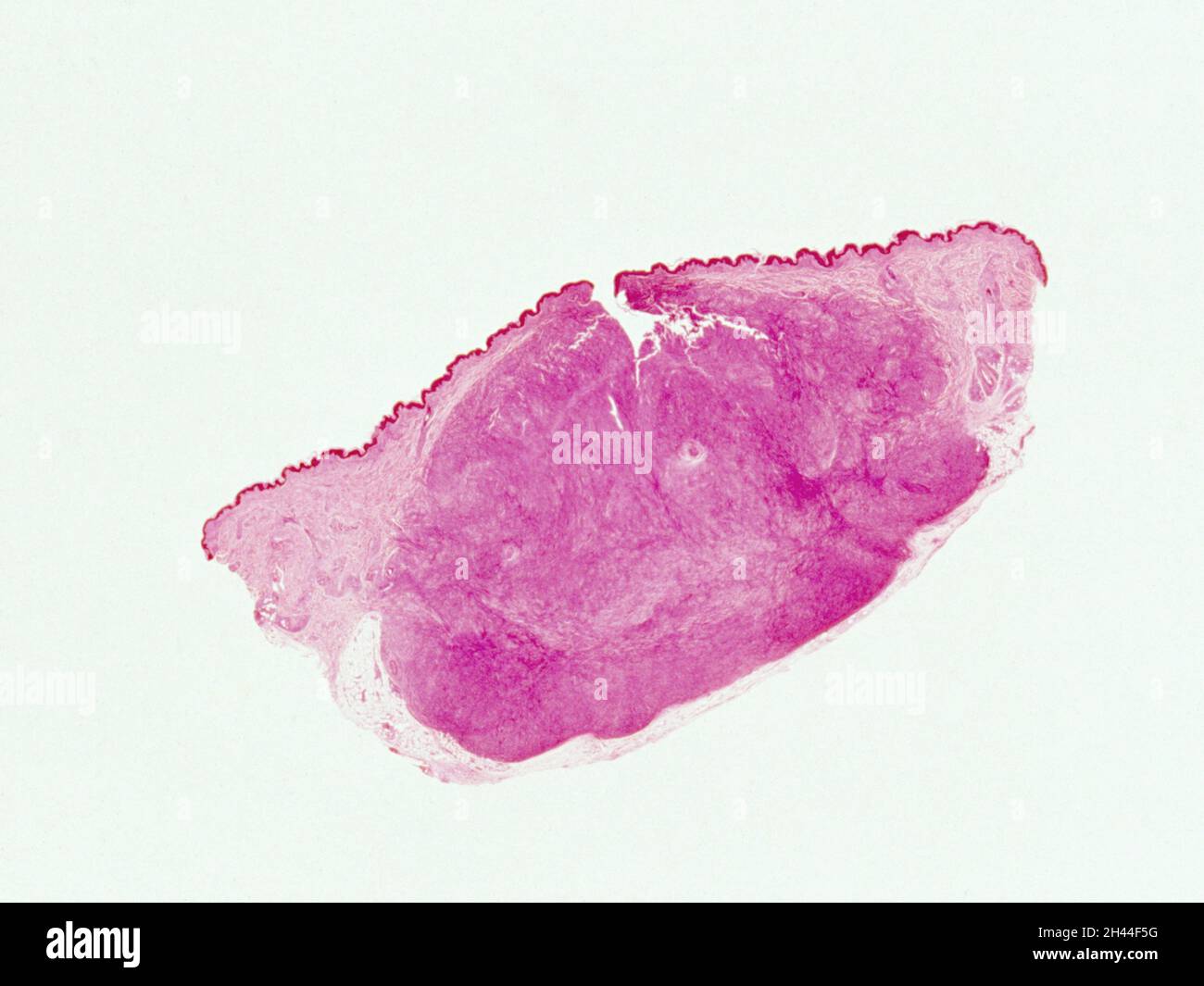 Lepromatous Leprosy High Resolution Stock Photography and Images - Alamy