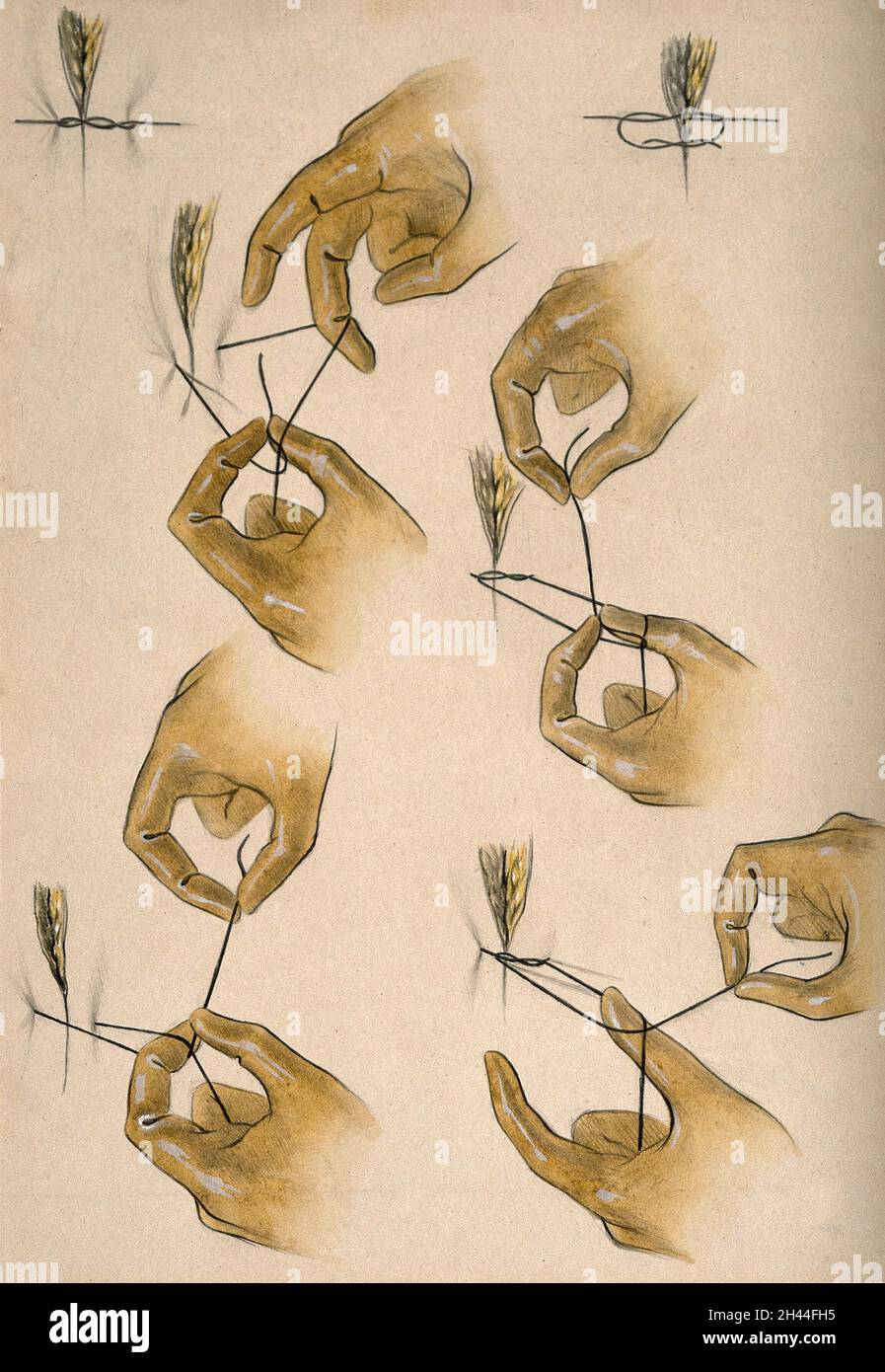 A gloved hand making surgical stitches. Coloured pencil drawing, 19 ...