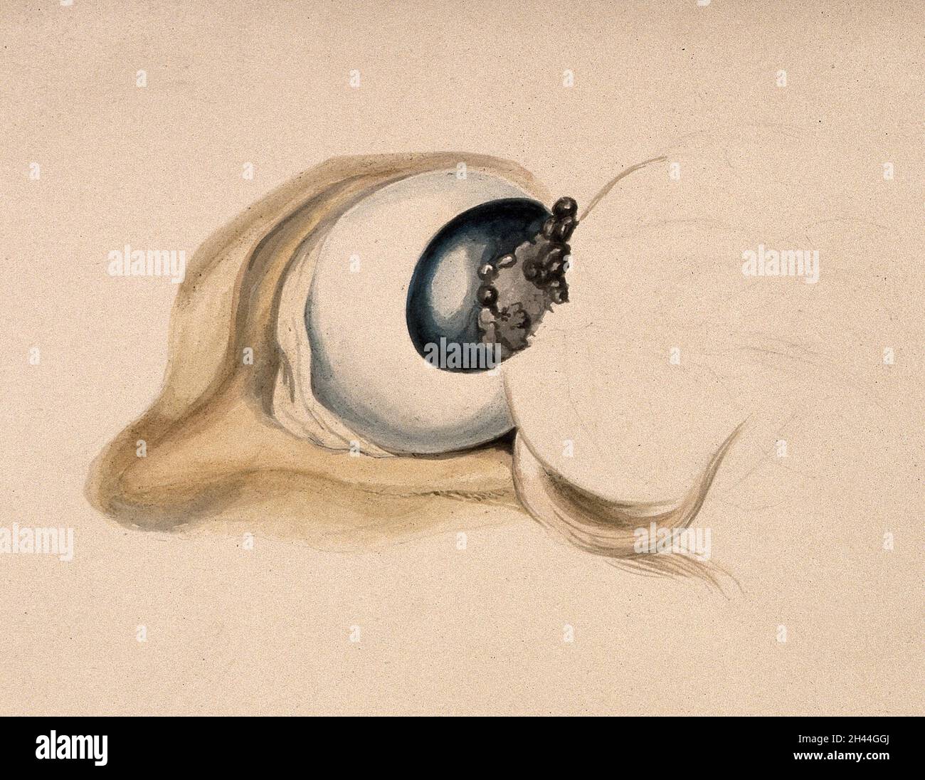 A diseased eye. Watercolour Stock Photo - Alamy