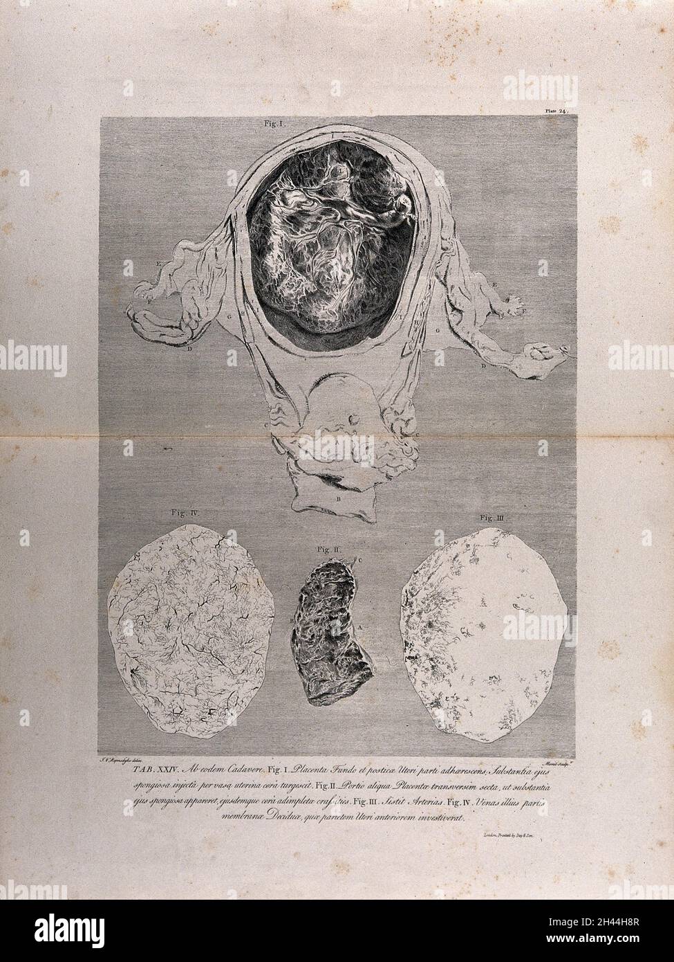 Dissection of the pregnant uterus at six months, showing the placenta ...