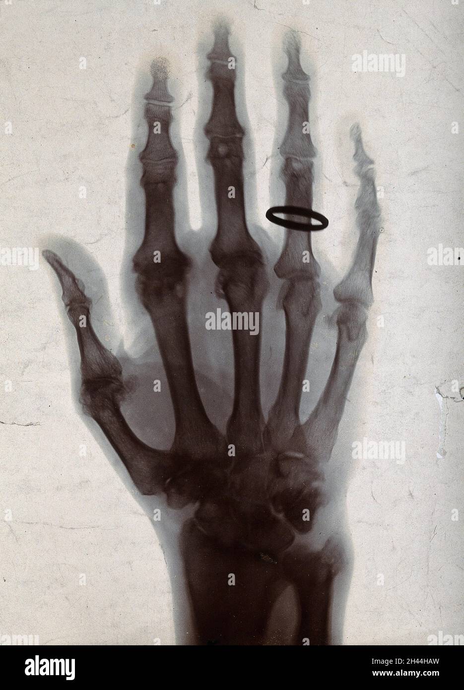 The bones of a hand, with a ring on one finger, viewed through x-ray ...