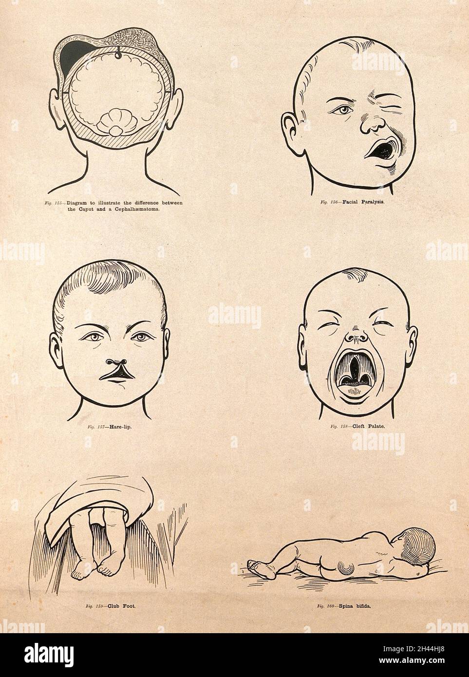 Birth-defects in the new-born child. Lithograph after W. F. Victor ...