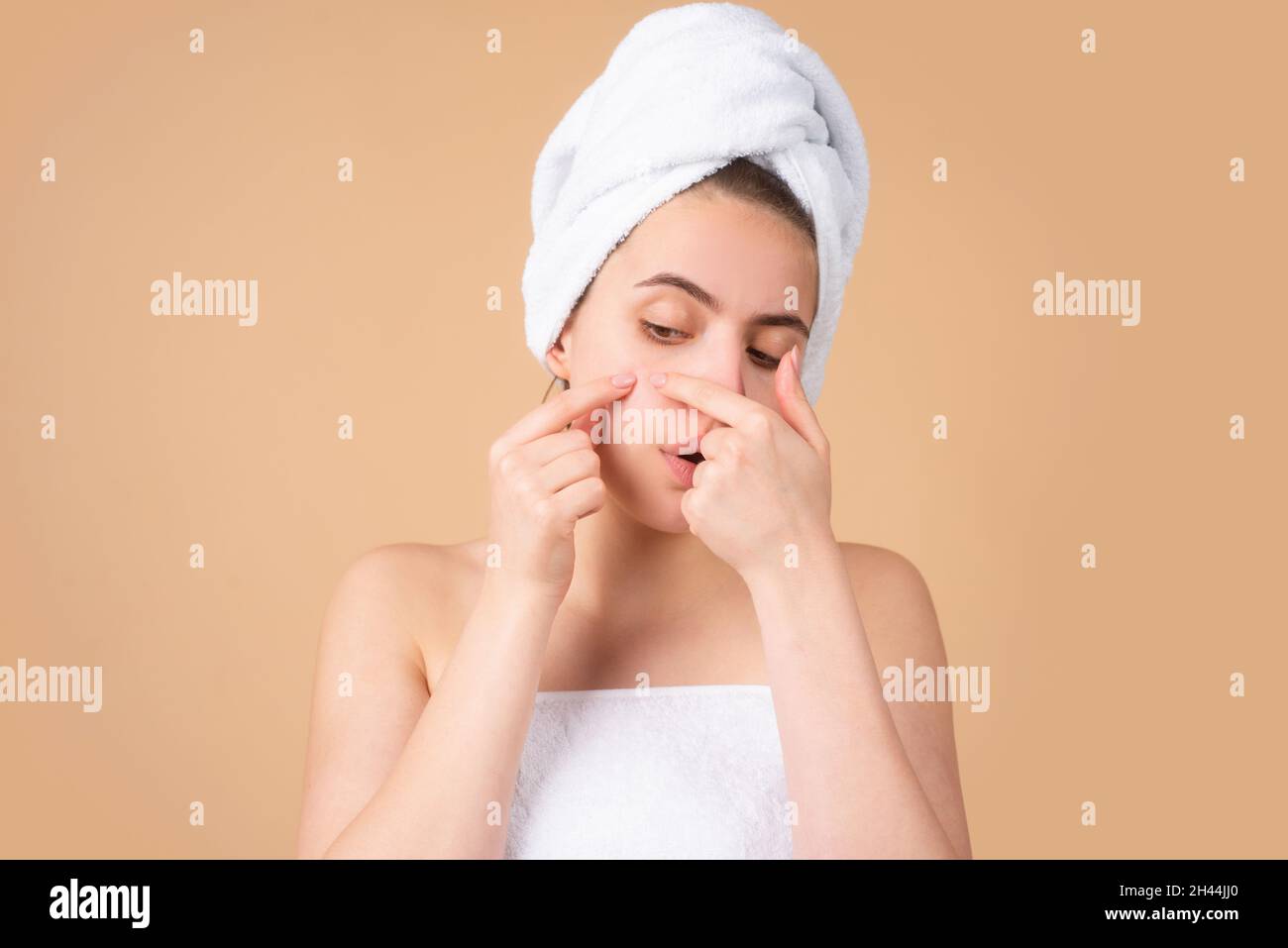 Woman squeezing pimples on her face. Acne blemish spots skin on young ...