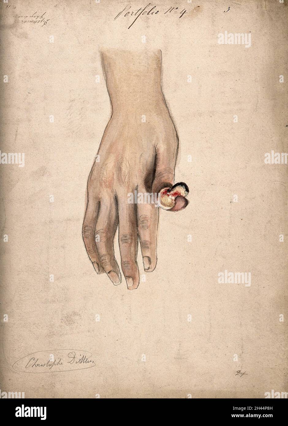 Diseased, deformed thumb showing symptoms of diphtheritic phagedena ...