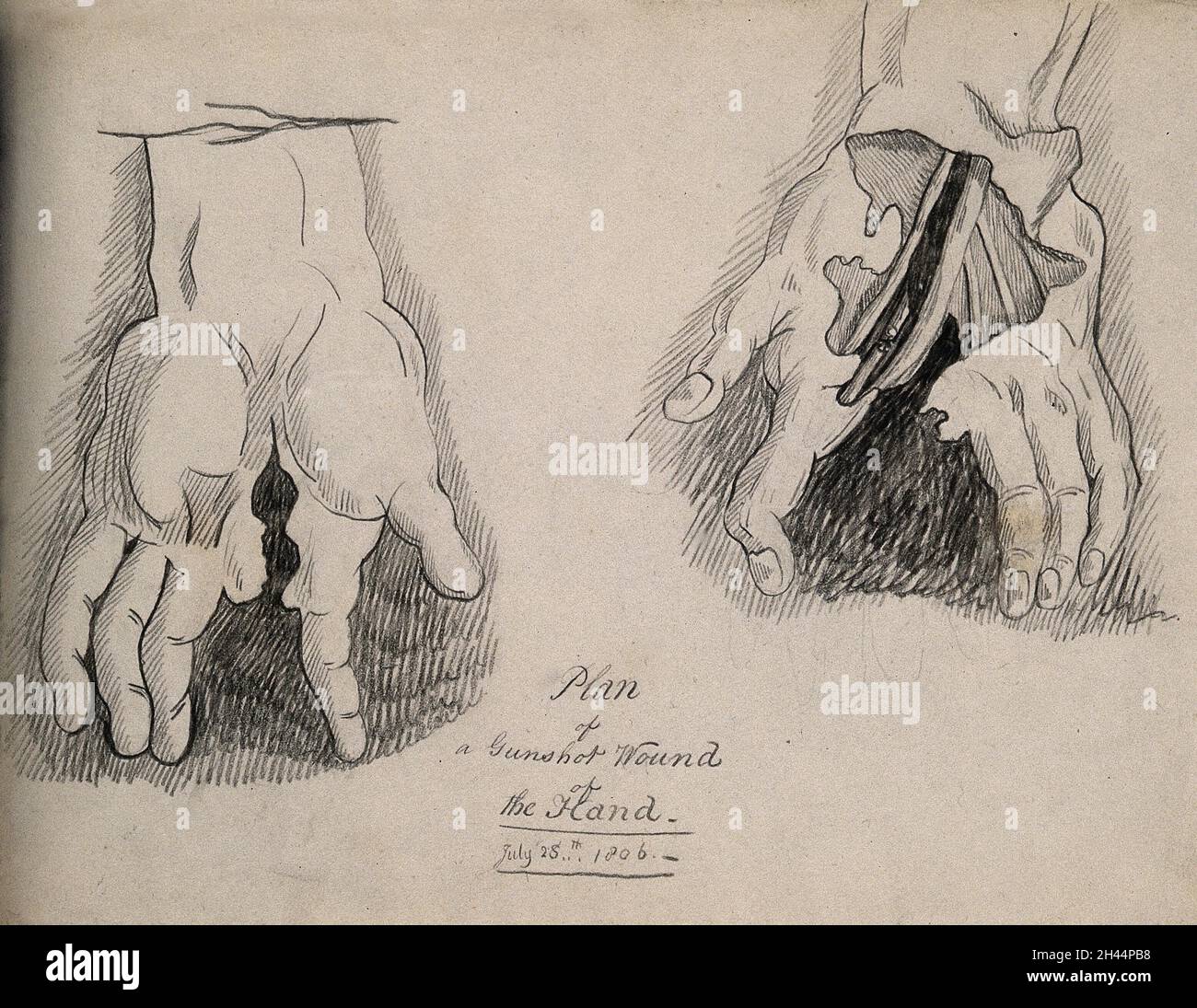 A wounded hand, having been torn apart between index and second finger ...