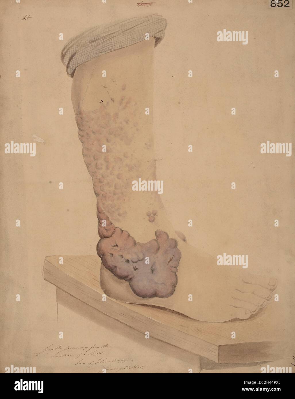 Leg and foot with extensive keloid growths in the cicatrices following ...