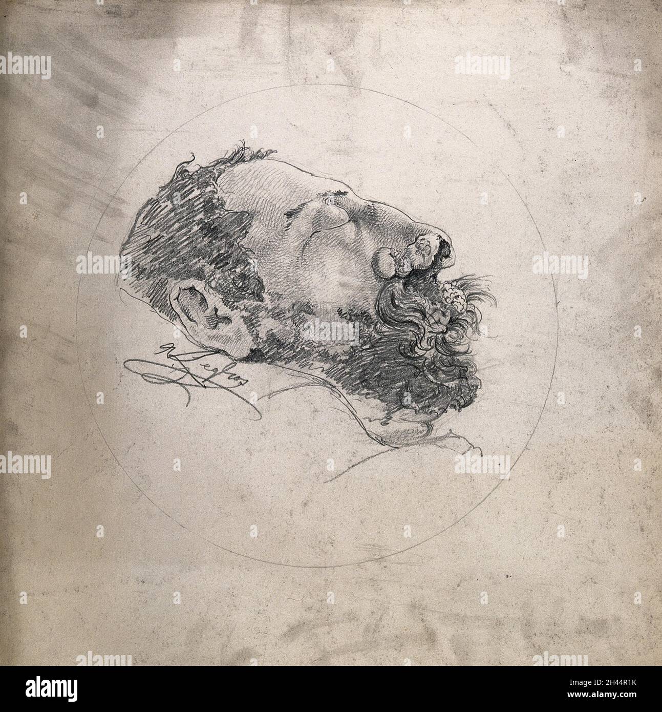 Face of a dead (?) man suffering from syphilis, showing a severely ...