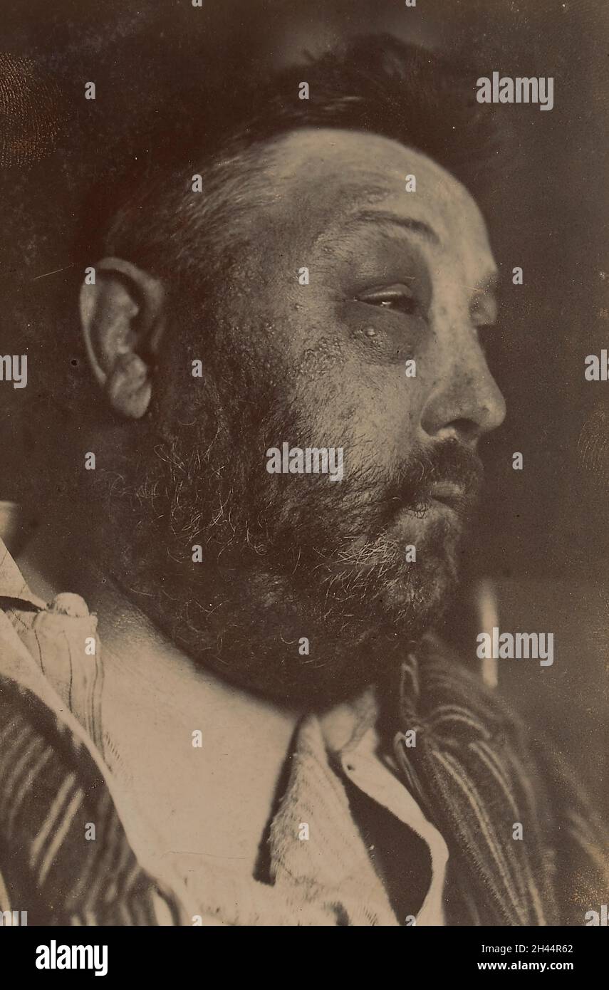 Face of man with partial swelling of the right side of the face Stock ...