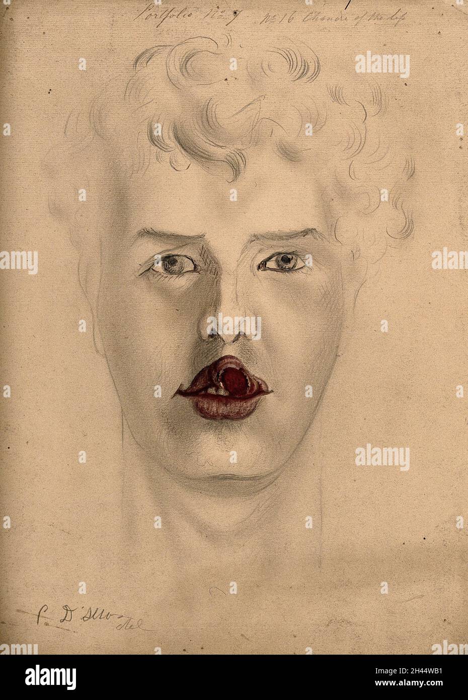 Face of a man suffering from chancre of the lip. Watercolour by C. D ...