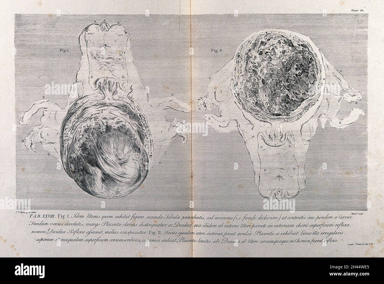 Dissections of a pregnant uterus at five months: two figures, one ...
