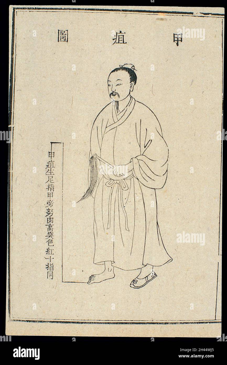 Chinese C18 woodcut: External medicine - Toenail ulcer Stock Photo - Alamy