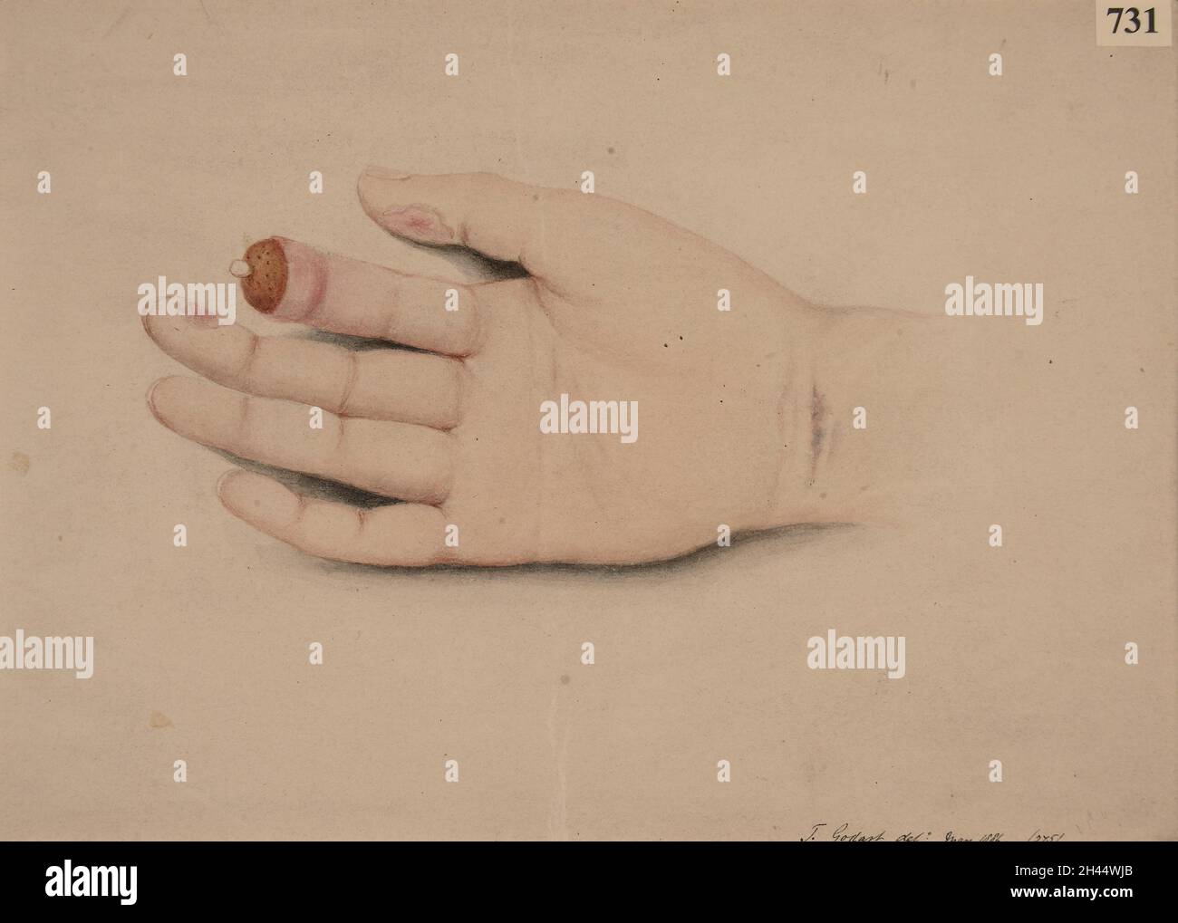 Destructive ulceration of the distal phalanx of the forefinger due to ...