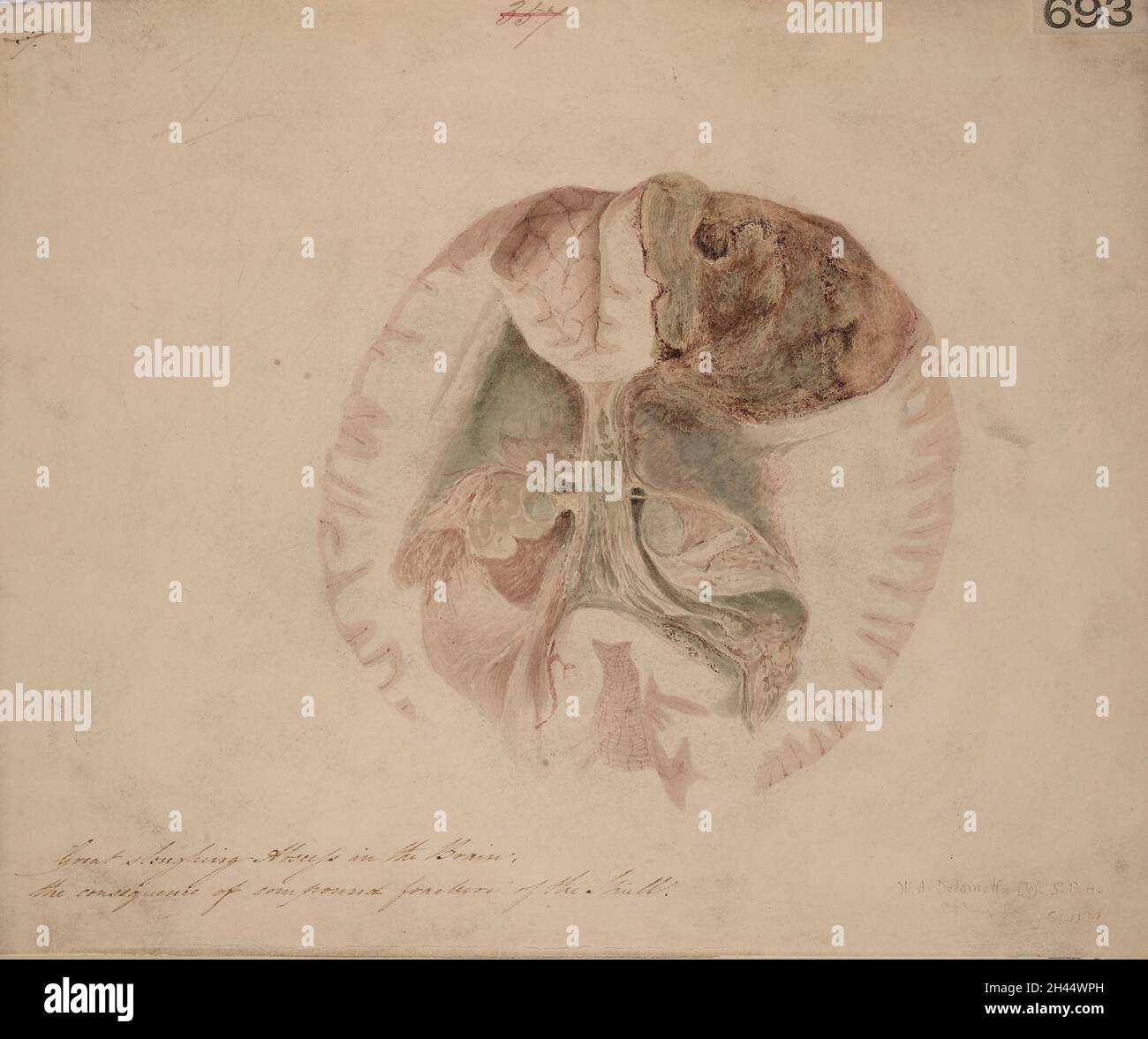 Compound fracture hi-res stock photography and images - Alamy