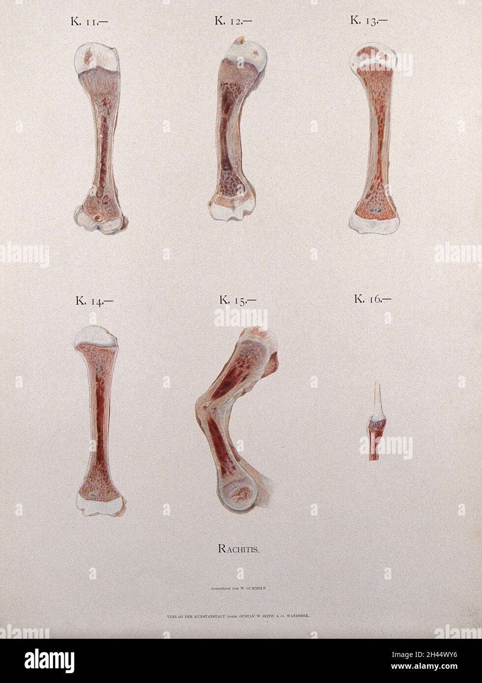 Sections through bones affected by rickets. Chromolithograph by W ...