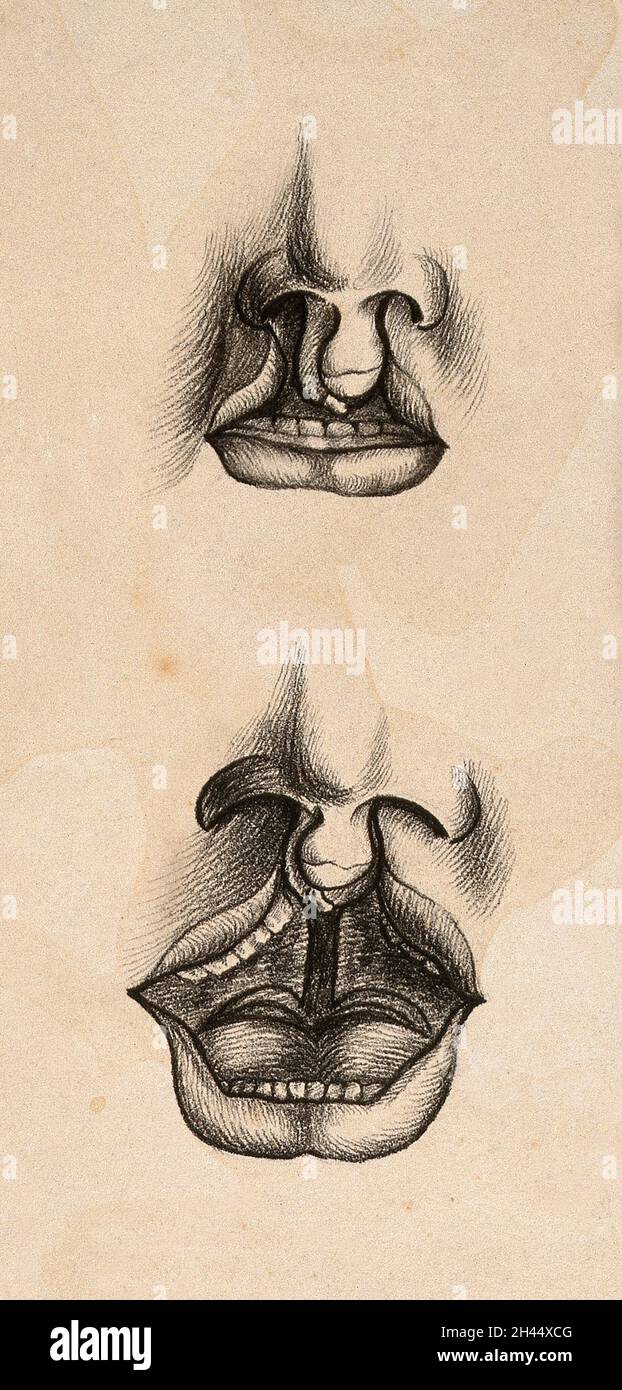 Two examples of mouth deformities: cleft lip. Drawing Stock Photo - Alamy