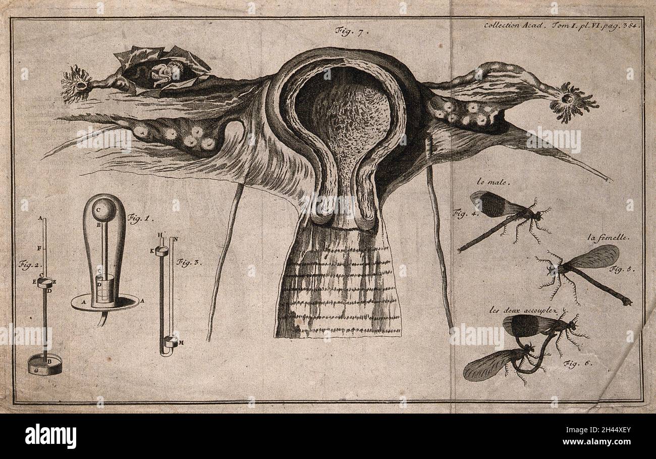 Dissection of the female reproductive organs, showing an ectopic ...