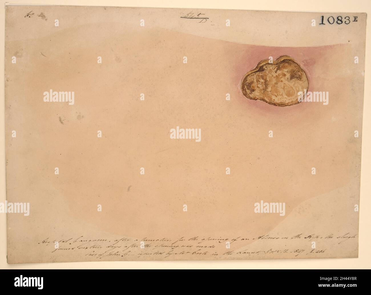 Hospital gangrene affecting the hip following a puncture of an abscess ...