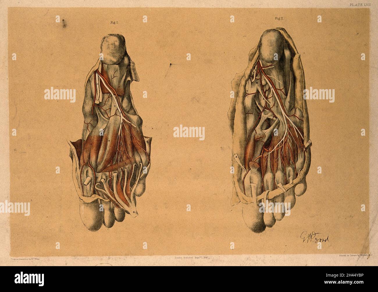 Dissections of the underside of the foot, showing the muscles, bones ...