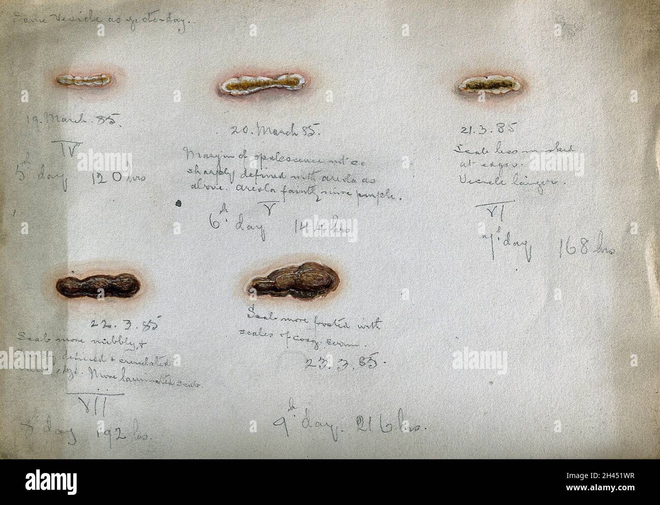 Calf (cowpox) vaccine pustules: five stages from the fifth to the ninth ...