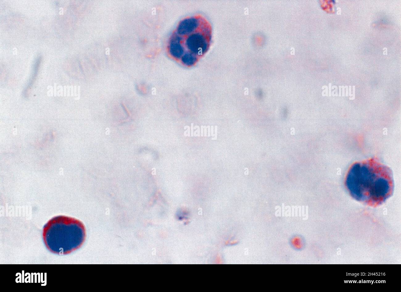 Fragile x syndrome hi-res stock photography and images - Alamy