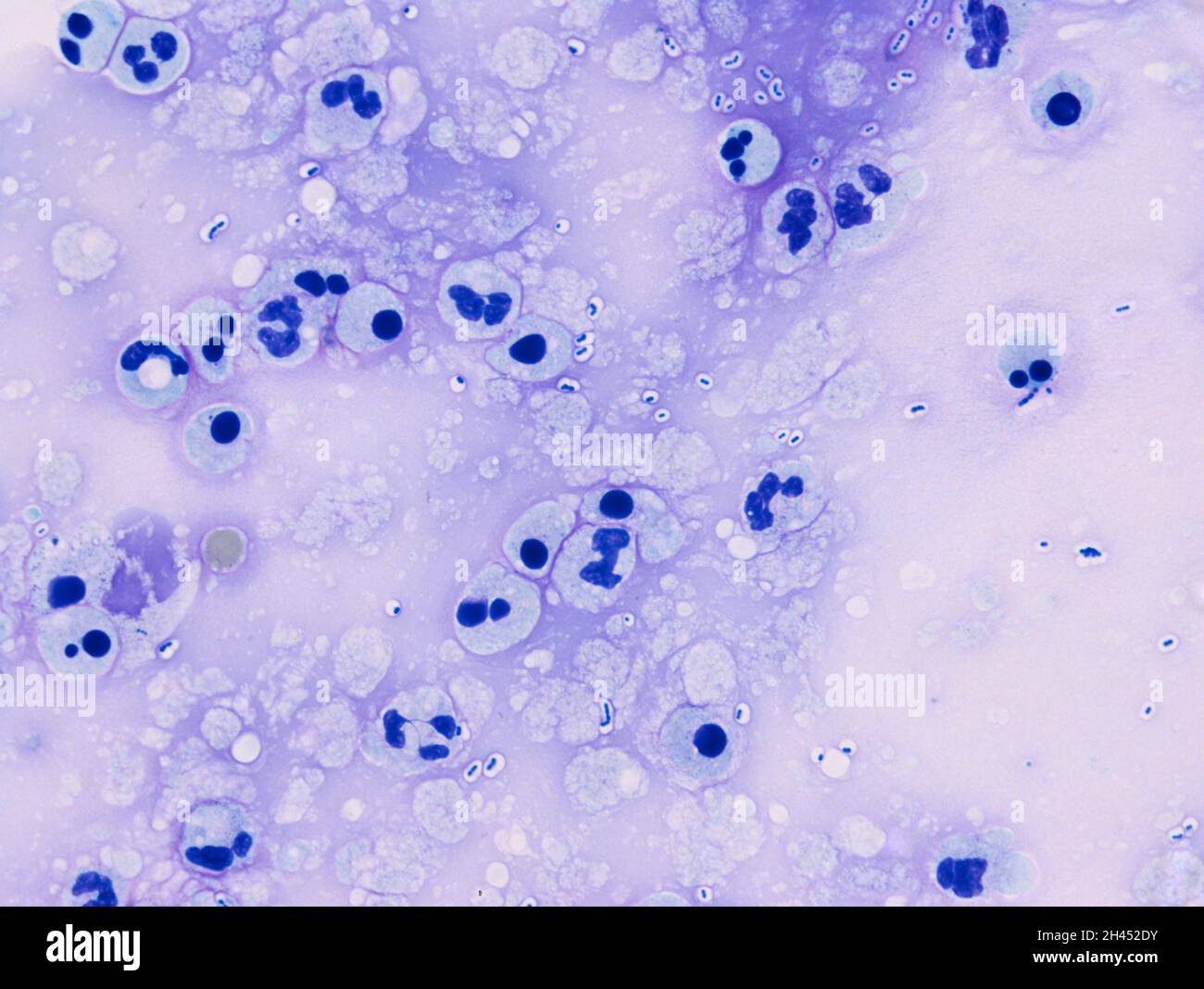 Streptococcus pneumoniae meningitis CSF Stock Photo - Alamy