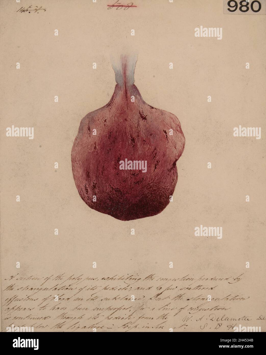 Section of a polypus which grew from the upper cavity of the uterus ...