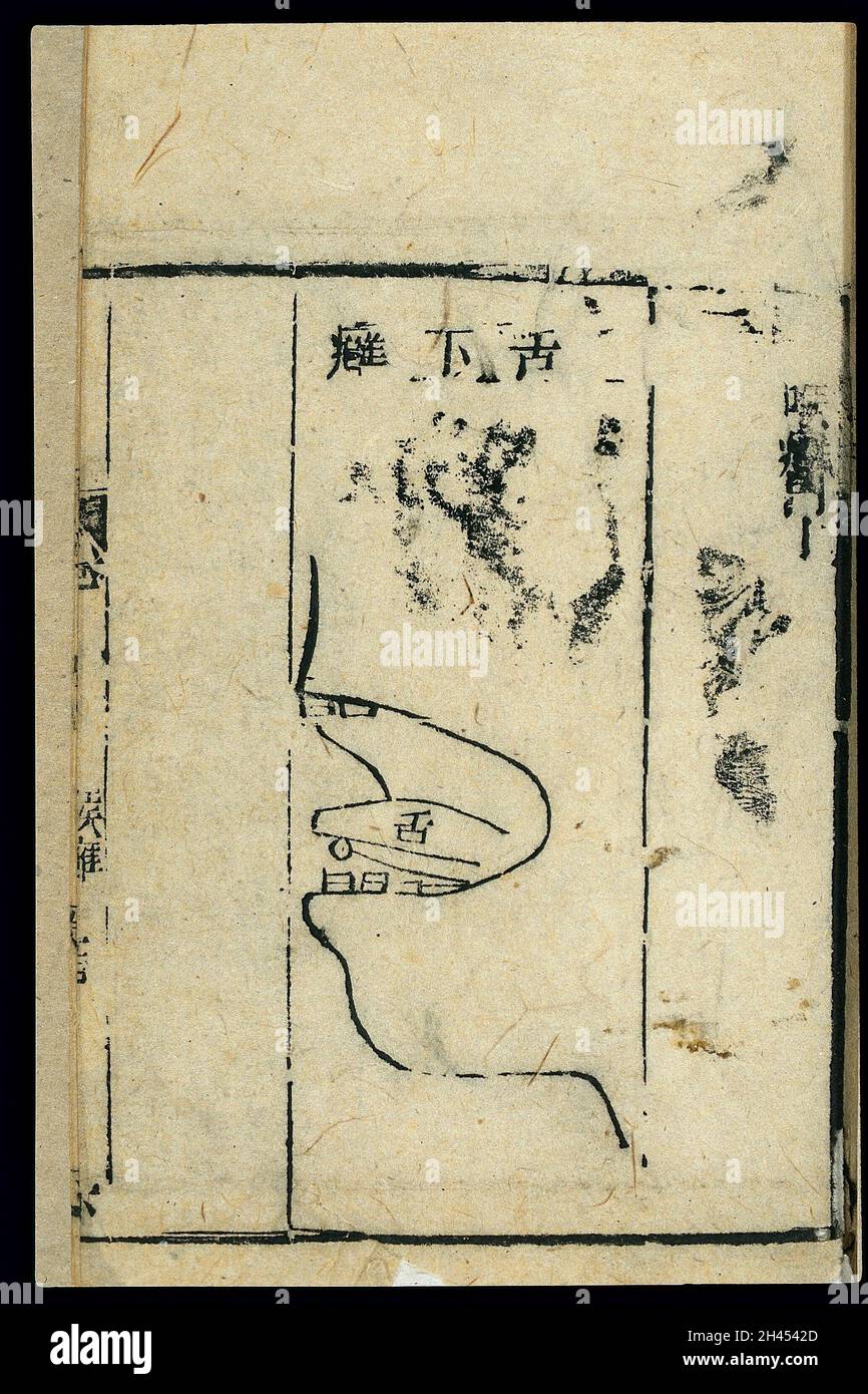 Chinese C19 woodcut: Abscesses beneath the tongue Stock Photo - Alamy