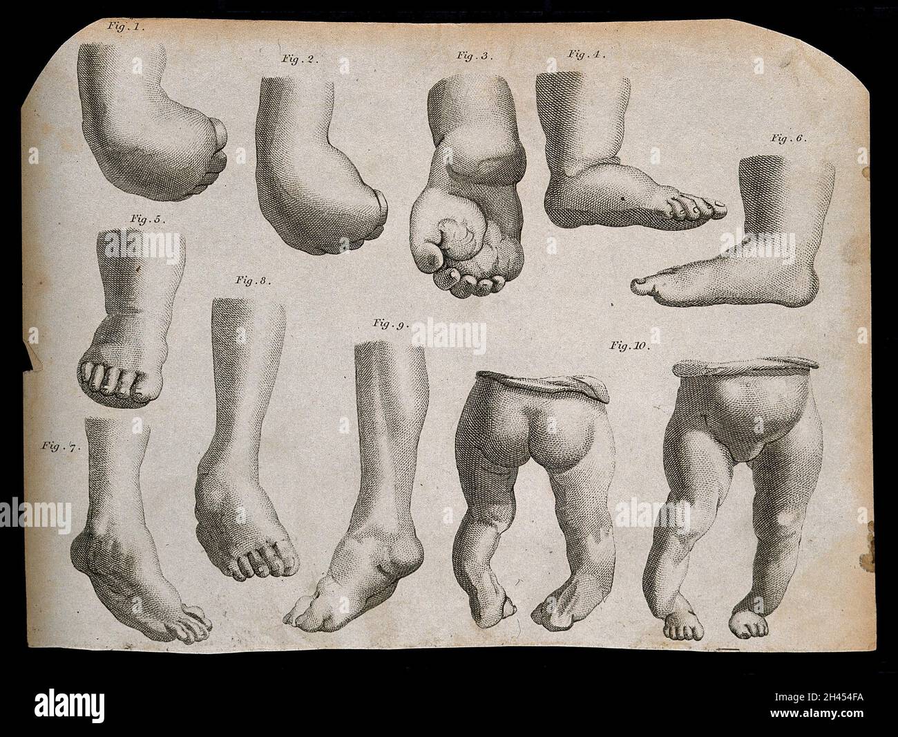 Deformed feet hi-res stock photography and images - Alamy