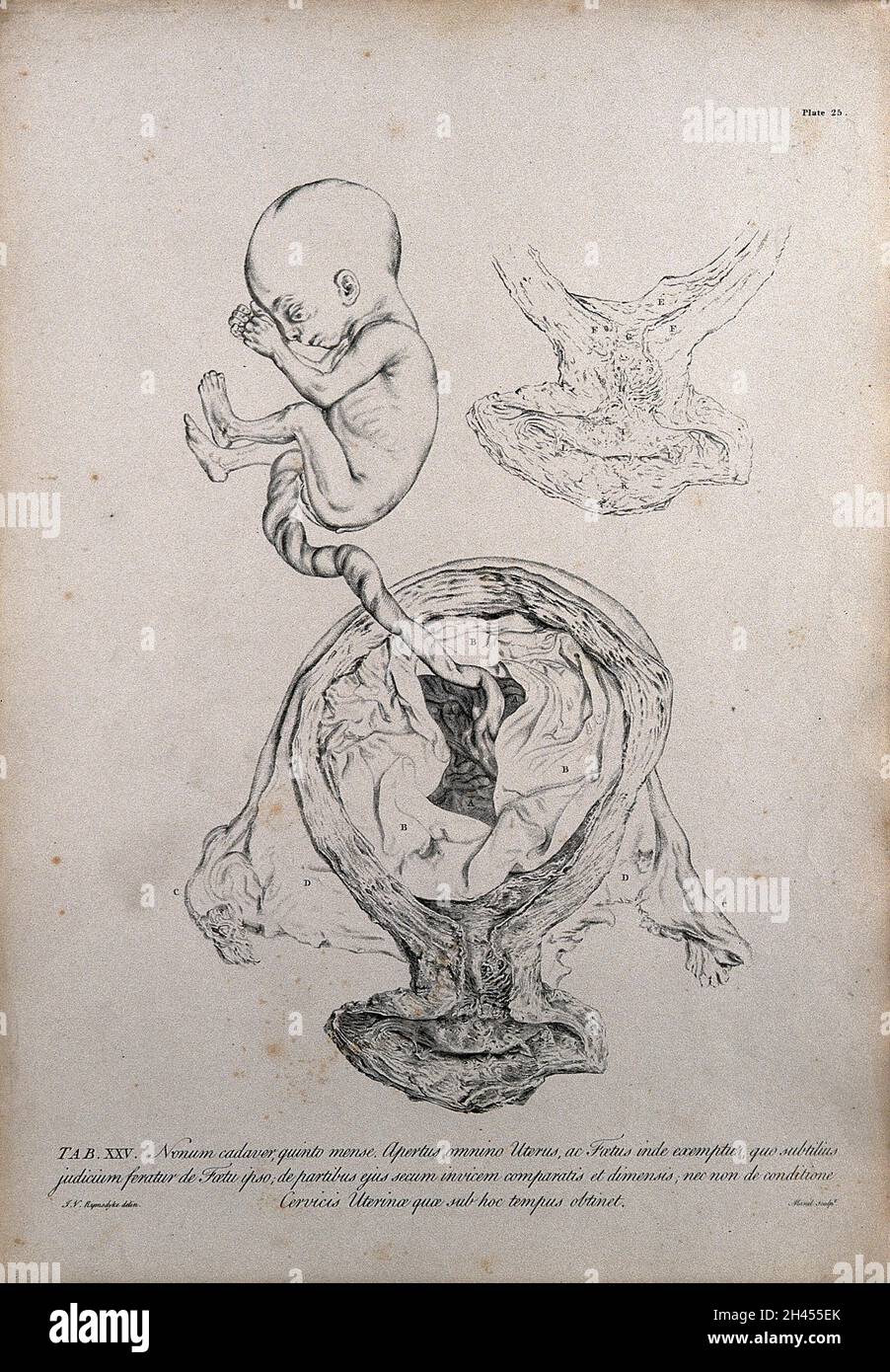 Dissection of the pregnant uterus at five months, showing the foetus ...