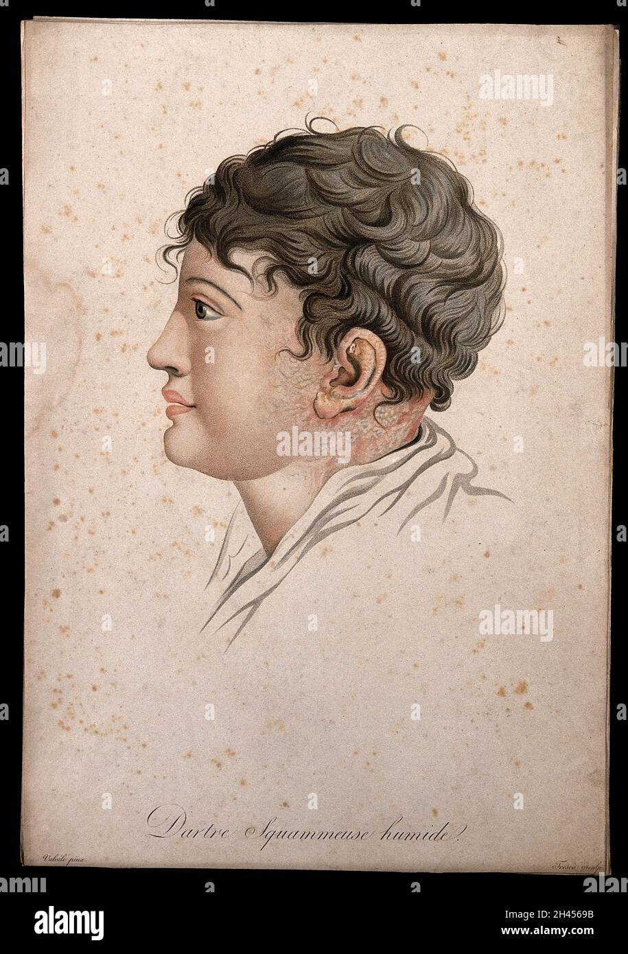 Head of a woman with a skin disease on her neck. Coloured stipple ...