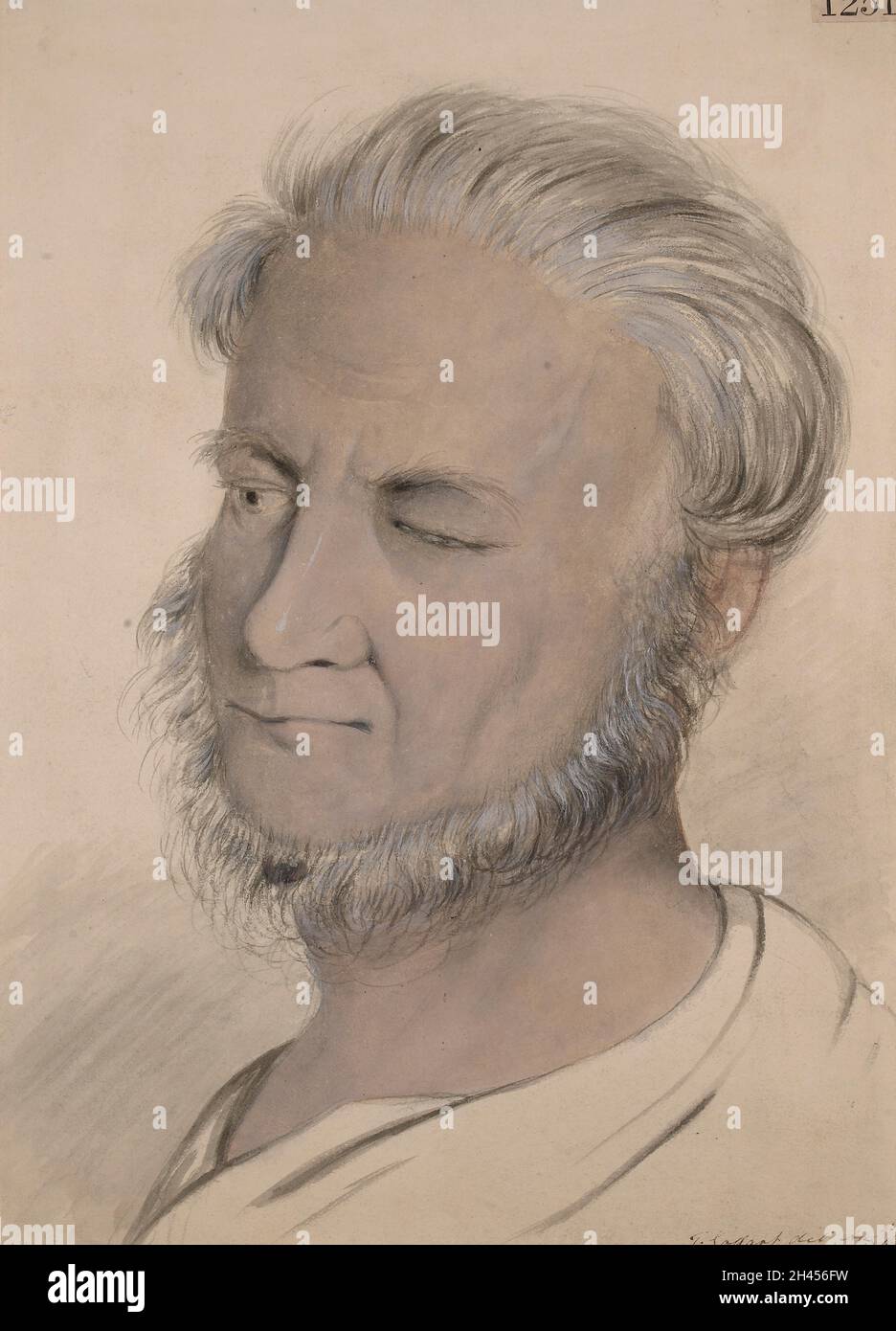 Face of a man with peculiar staining of the skin, caused by melanotic ...