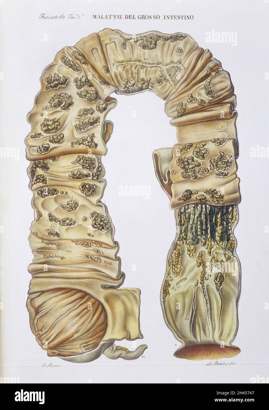 Diseases of the large intestine Stock Photo - Alamy