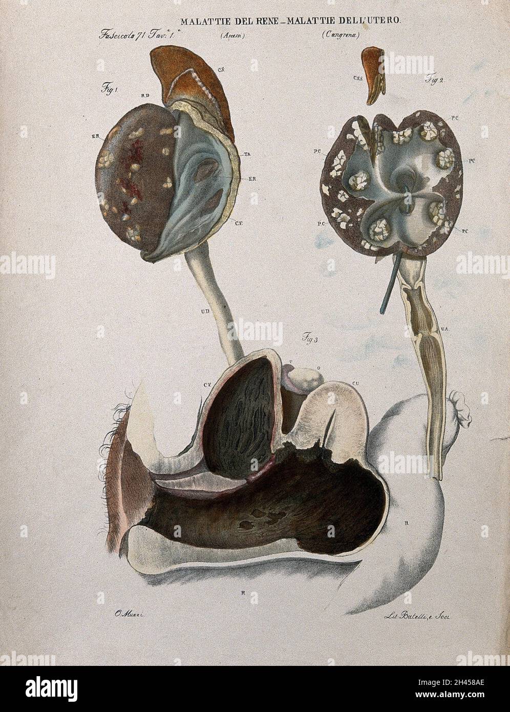 A diseased kidney (abscess) and diseased uterus (gangrene), numbered ...