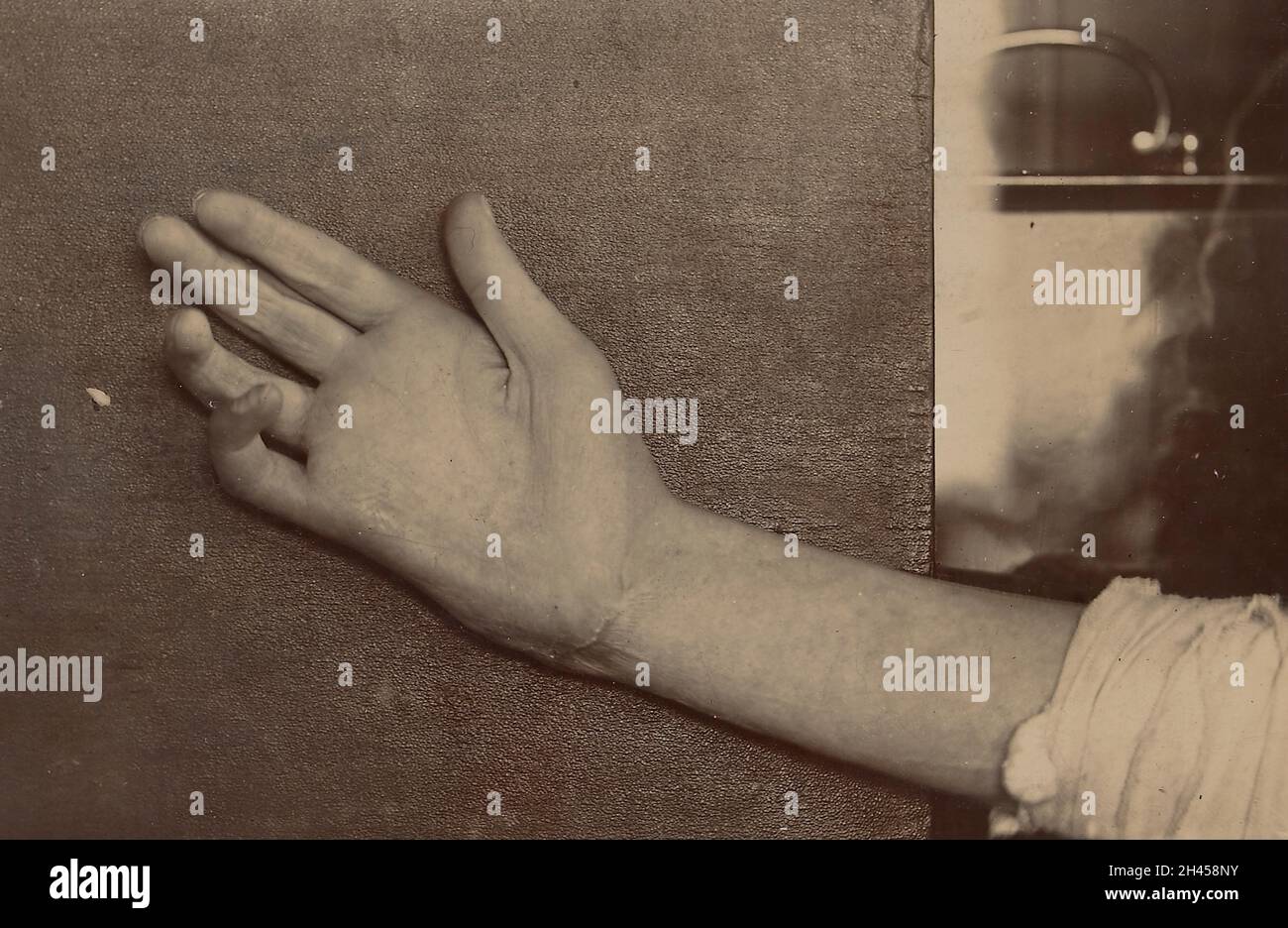 Right hand and forearm of a boy suffering from paralysis of the ulnar ...