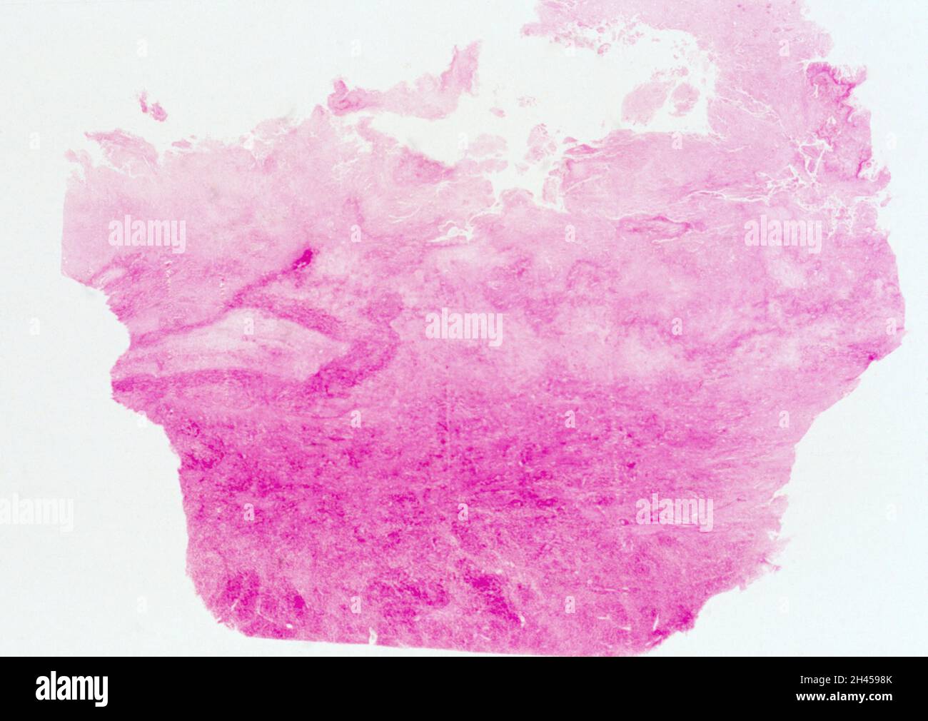 Amoebiasis: amoebic abscess in liver Stock Photo - Alamy