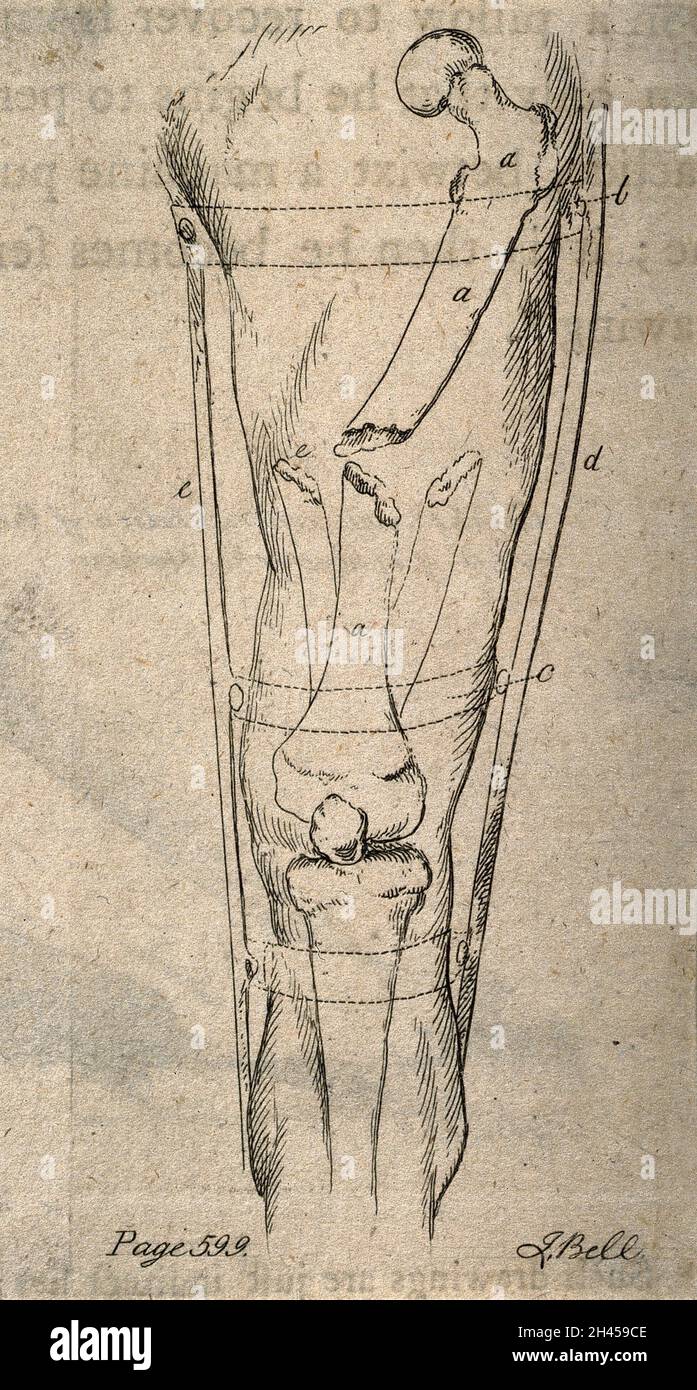 A diagram illustrating an apparatus to bind together a broken leg ...