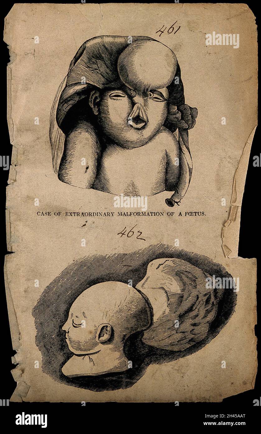 A malformed foetus. Wood engraving Stock Photo - Alamy