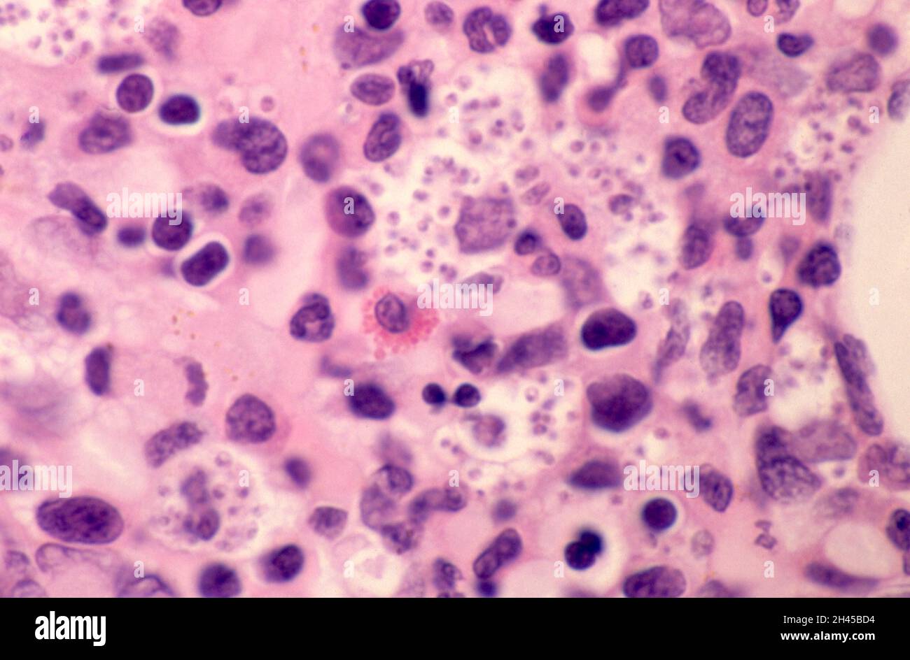 Bone marrow: leishmaniasis with HIV Stock Photo - Alamy