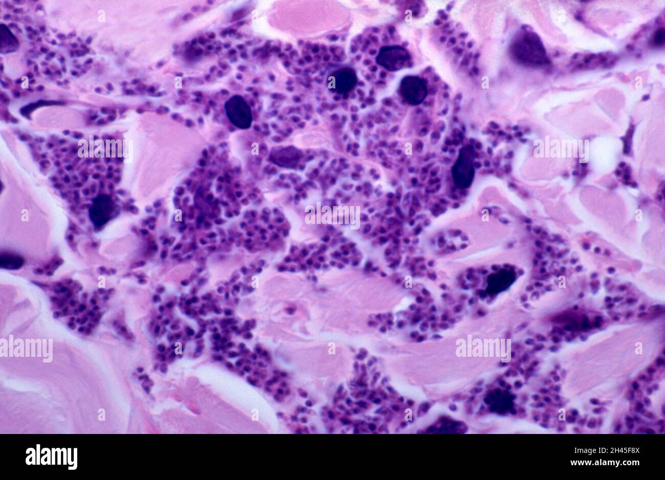 Cutaneous leishmaniasis hi-res stock photography and images - Alamy