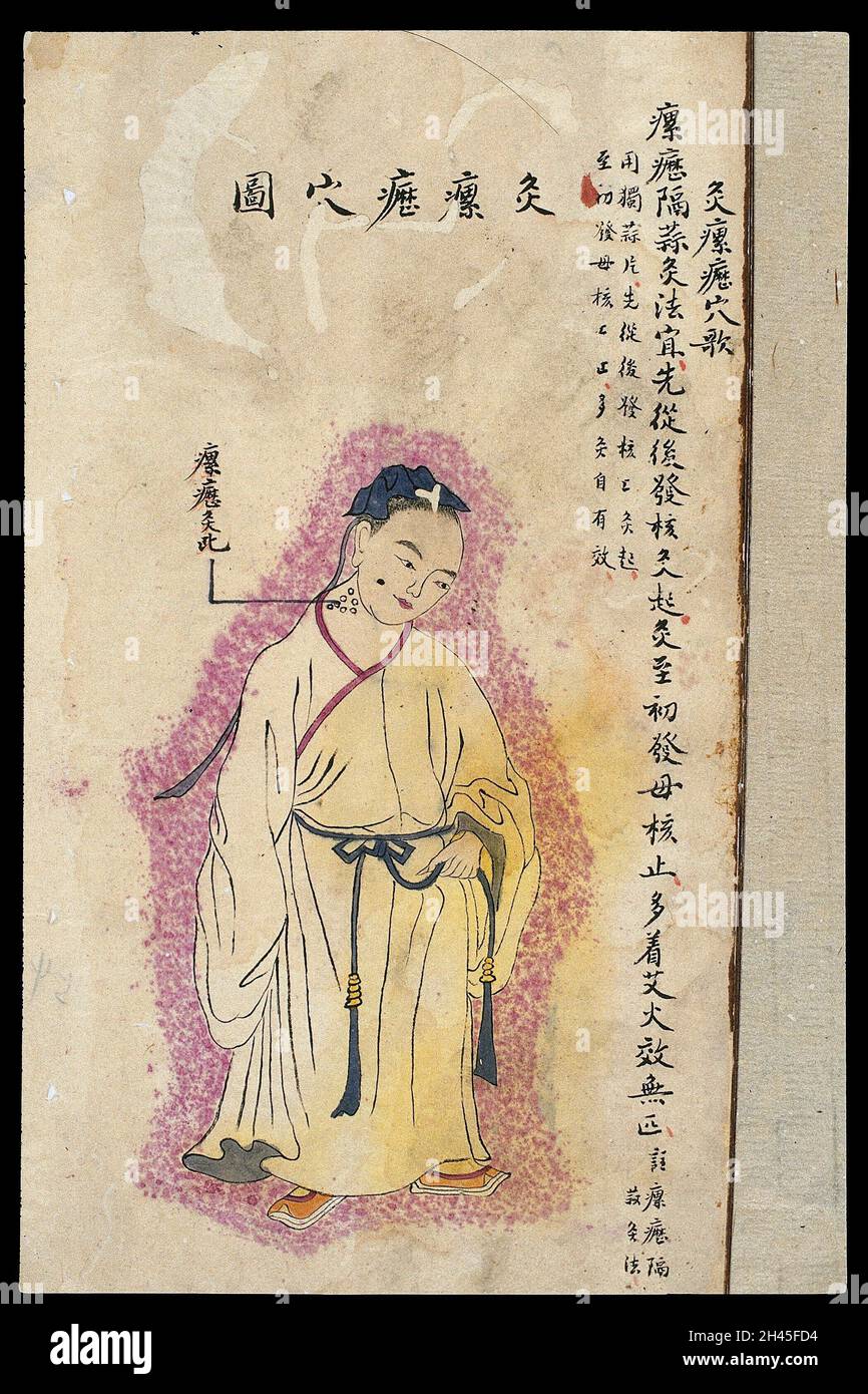 C19 Chinese MS moxibustion point chart: Scrofula point Stock Photo - Alamy