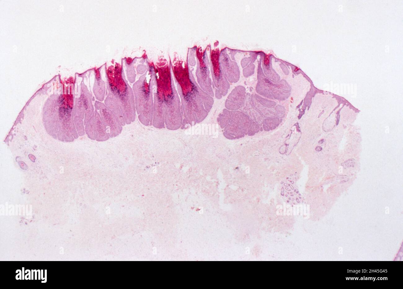 Contagiosum hi-res stock photography and images - Alamy