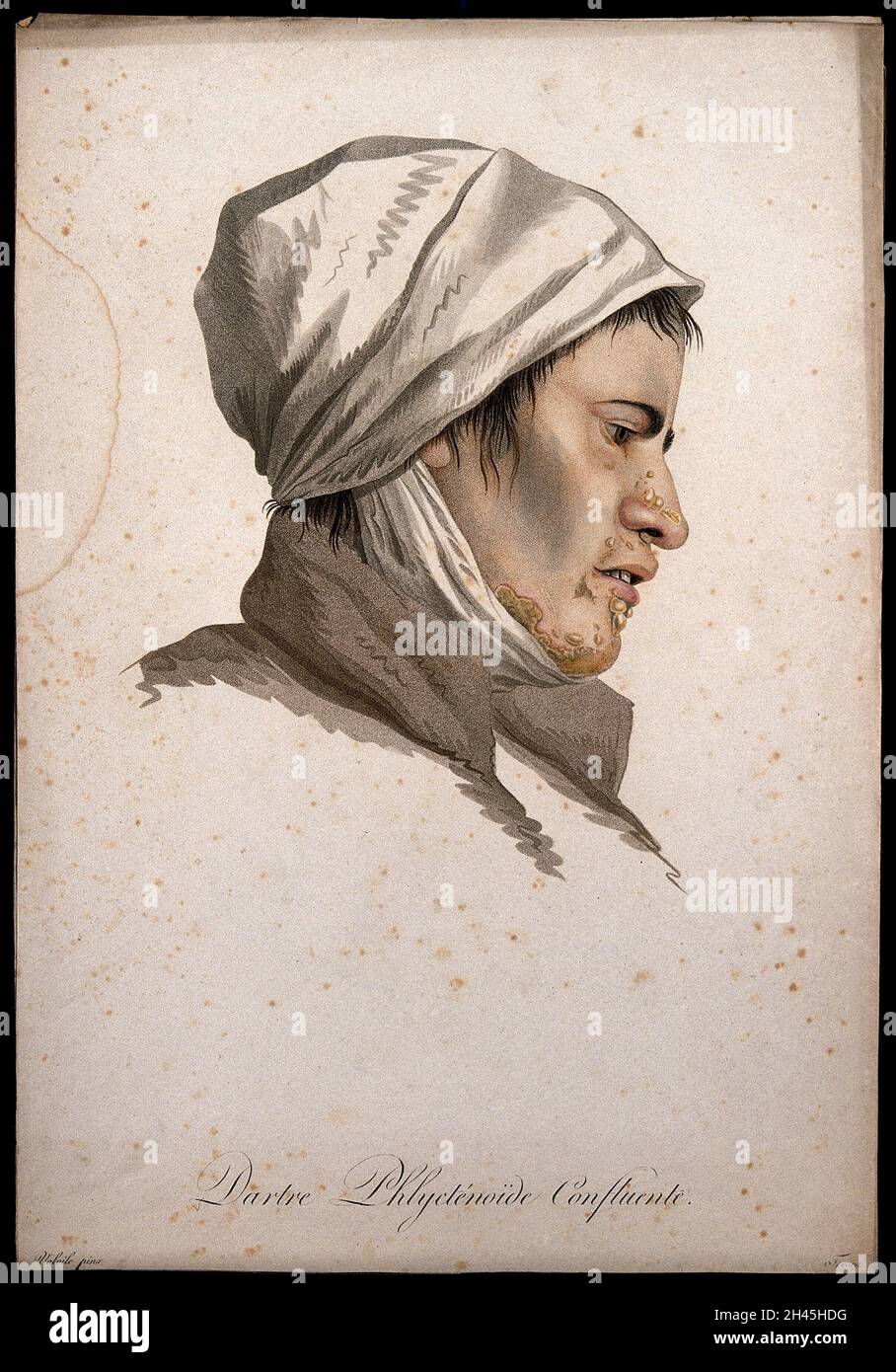 Head of a man with a skin disease on his nose and chin. Coloured ...