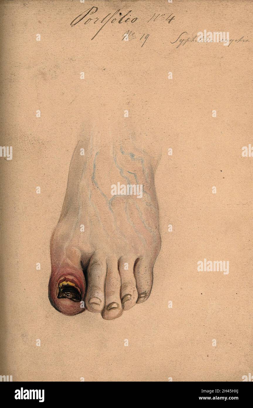 Diseased tissue on the toe and nail of a woman (?), showing symptoms of ...