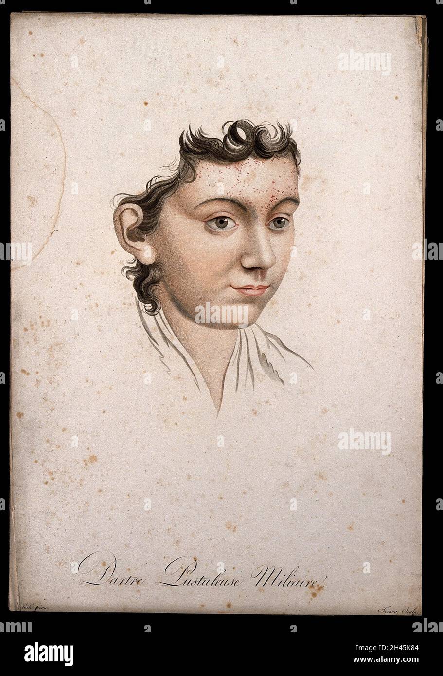 Head of a woman with a skin disease on her forehead. Coloured stipple ...